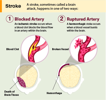 Pediatric Stroke